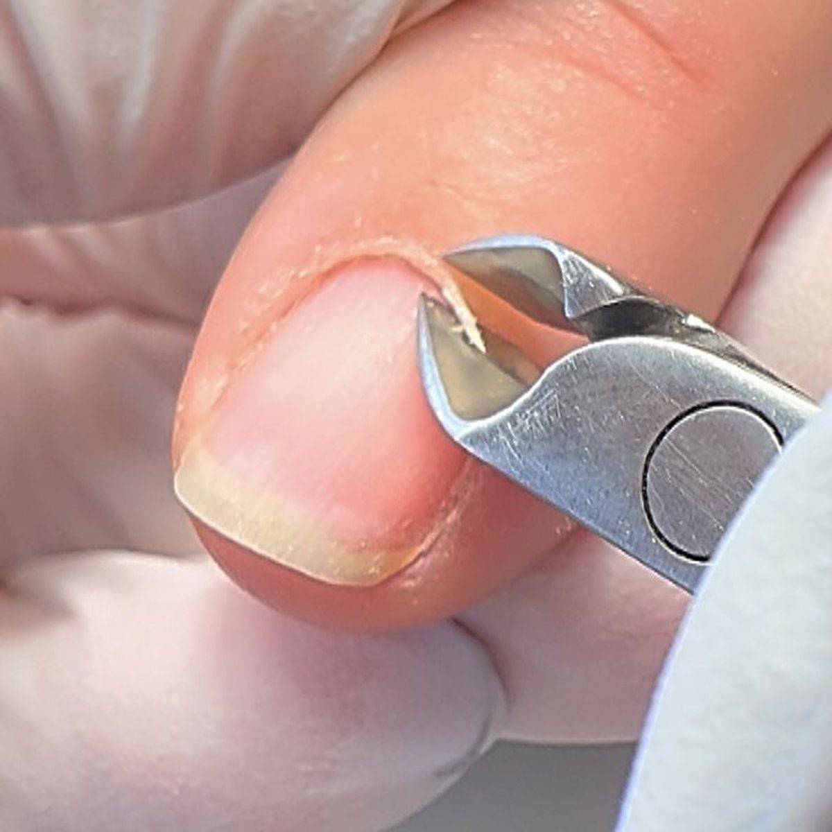 Các Bệnh Về Móng Chân Thường Gặp Nhất